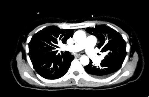 CT scan PE 3 bars - Thorax CTs - embodi3D.com