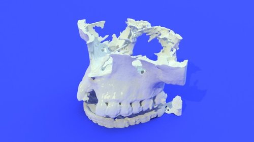 Maxilla with anterior bone defect 1100HU - stl file processed - Dental ...