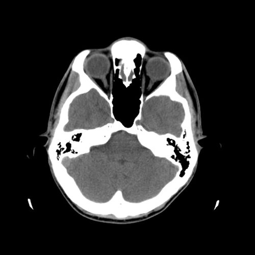 CT Scan - Skull, Head, and Neck CTs - embodi3D.com