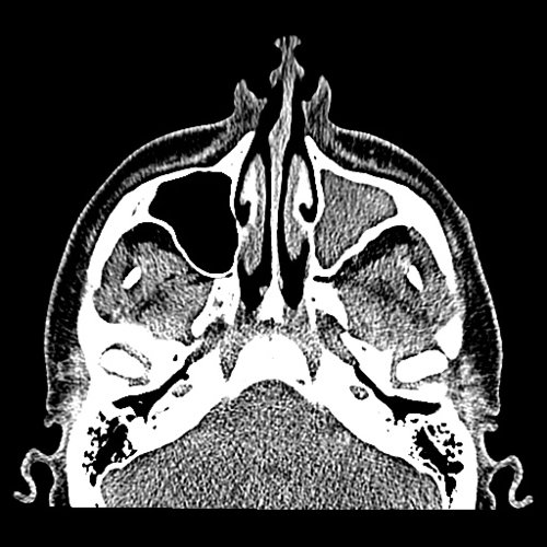 Chronic sinusitis - Dental, Orthodontic, Maxillofacial CTs - embodi3D.com