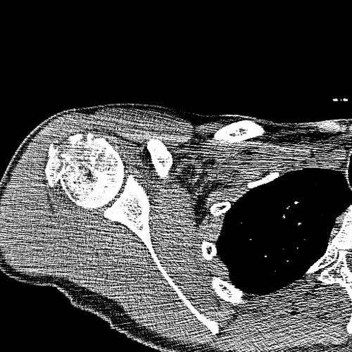 Scapula - Upper Extremity CTs - embodi3D.com
