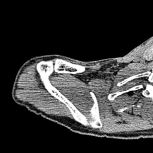 Shoulder CT - Upper Extremity CTs - embodi3D.com