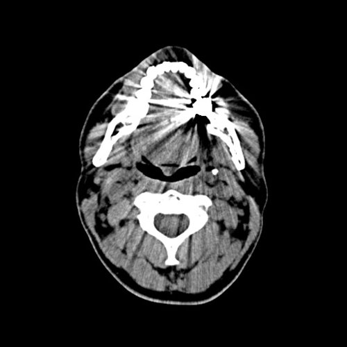 eagle syndrome - Skull, Head, and Neck CTs - embodi3D.com