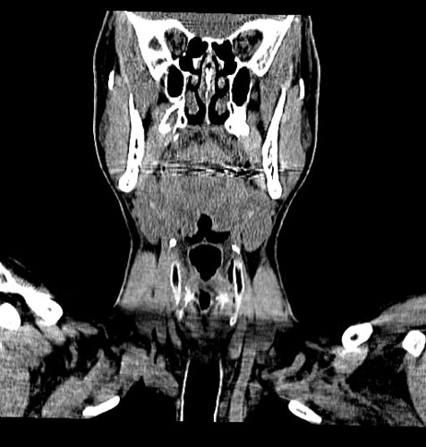 eagle syndrome - Skull, Head, and Neck CTs - embodi3D.com
