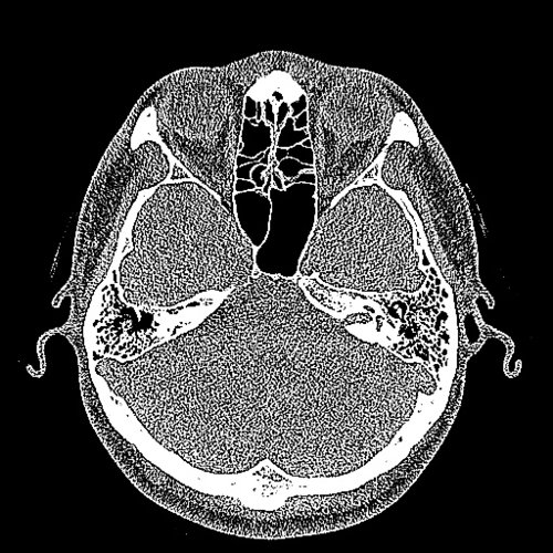 Head CT Scan - Skull, Head, and Neck CTs - embodi3D.com