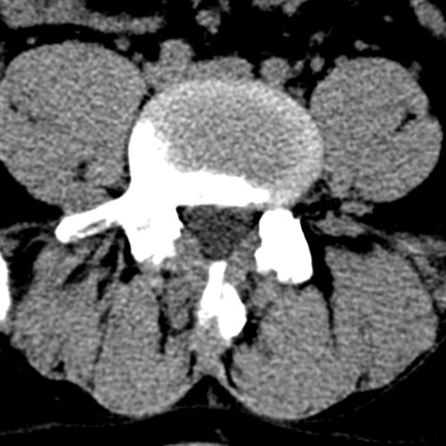LWS - Spine CTs - embodi3D.com
