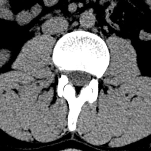 LWS - Spine CTs - embodi3D.com