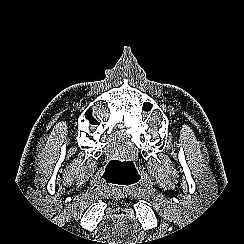 Skull with broken eye socket v2 - Dental, Orthodontic, Maxillofacial ...