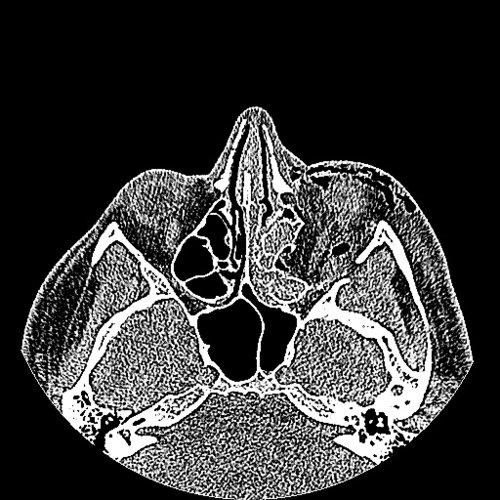 Skull with broken eye socket v2 - Dental, Orthodontic, Maxillofacial ...