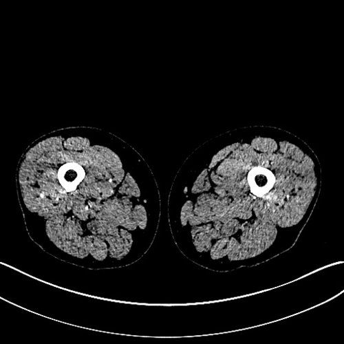 femur CT scan - Lower Extremity CTs - embodi3D.com