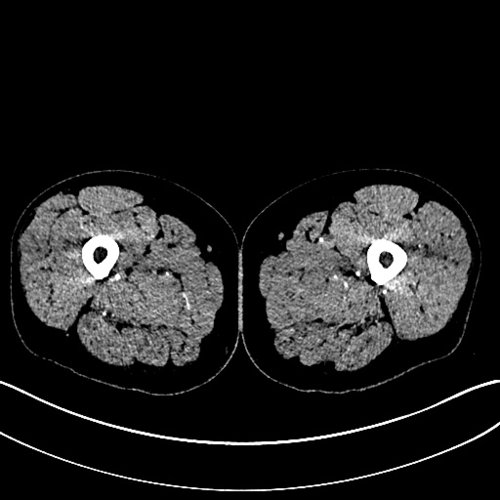 femur CT scan - Lower Extremity CTs - embodi3D.com