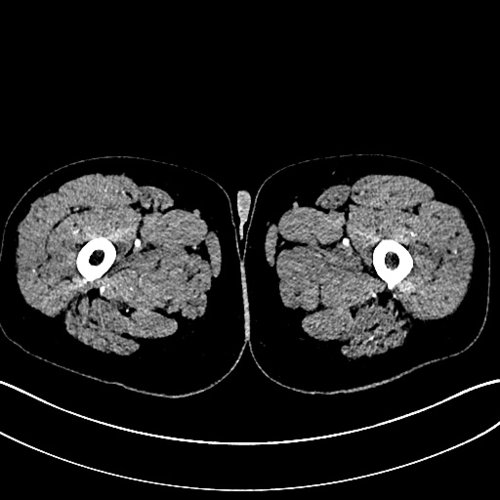 femur CT scan - Lower Extremity CTs - embodi3D.com