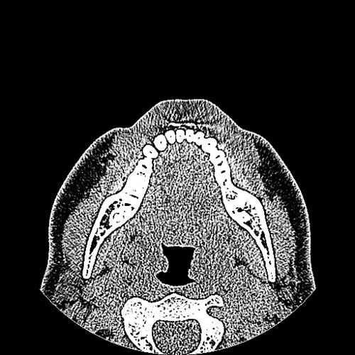 Skull with broken eye socket - Dental, Orthodontic, Maxillofacial CTs ...