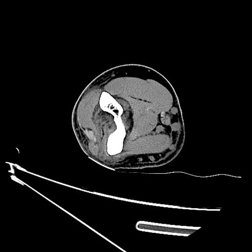 Left elbow CT scan - Upper Extremity CTs - embodi3D.com