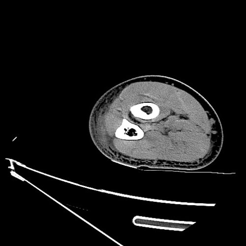 Left elbow CT scan - Upper Extremity CTs - embodi3D.com