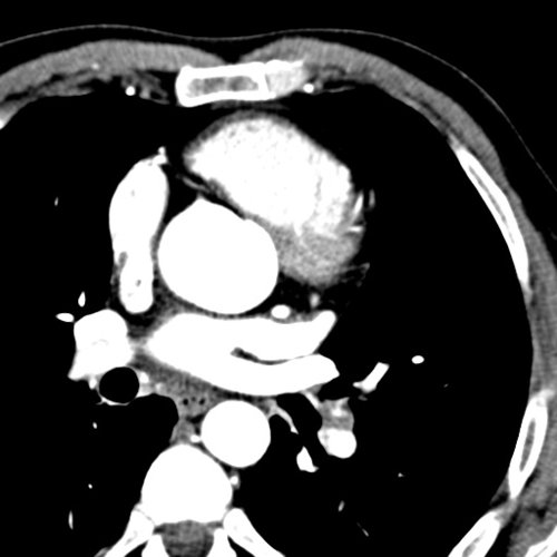 heart dicom - Thorax CTs - embodi3D.com