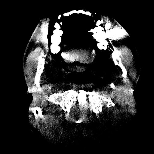 max fax surgery - Dental, Orthodontic, Maxillofacial CTs - embodi3D.com