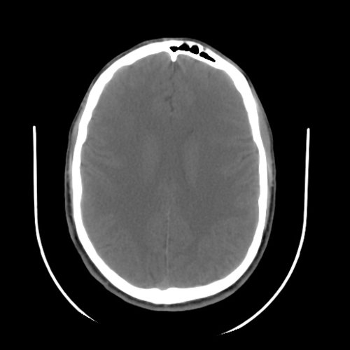 High IQ brain - 2009-07-04 - 26 years old - Skull, Head, and Neck CTs ...