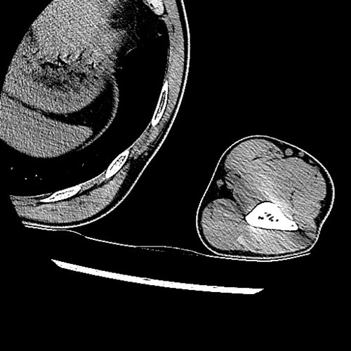 CT Scapula and humerus - Upper Extremity CTs - embodi3D.com