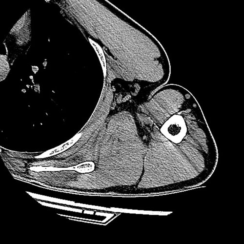 CT Scapula and humerus - Upper Extremity CTs - embodi3D.com