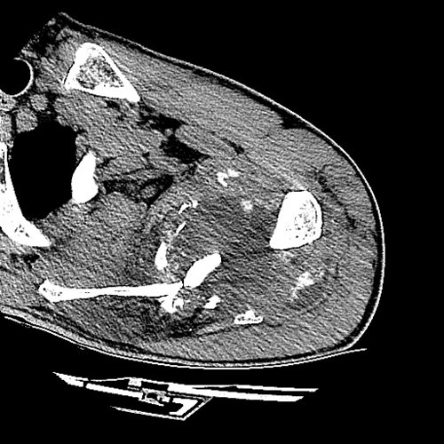 CT Scapula and humerus - Upper Extremity CTs - embodi3D.com