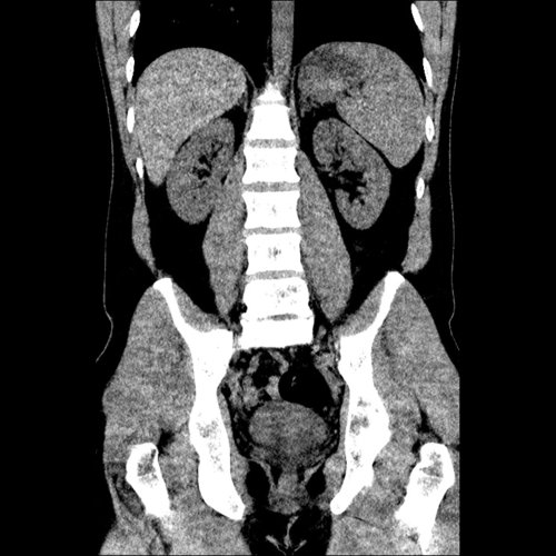 Lumbar CT - Spine CTs - embodi3D.com