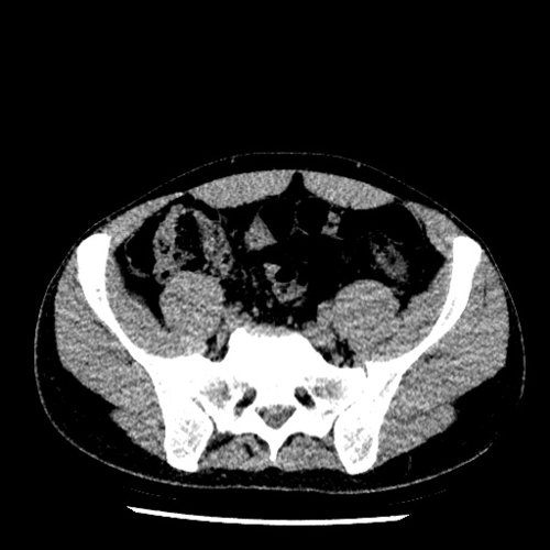Lumbar CT - Spine CTs - embodi3D.com