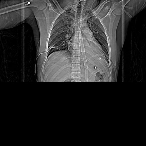 topogram - Thorax CTs - embodi3D.com