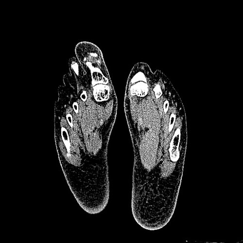 rt leg trauma lt leg comparison - Lower Extremity CTs - embodi3D.com