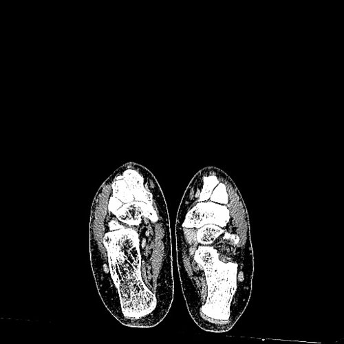 rt leg trauma lt leg comparison - Lower Extremity CTs - embodi3D.com