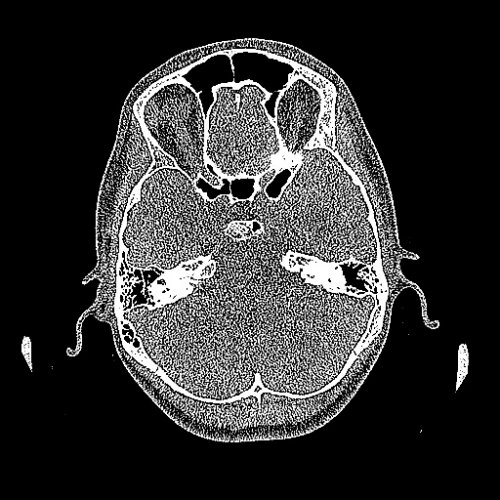 Head_CT_Bone_pediatric - Skull, Head, and Neck CTs - embodi3D.com
