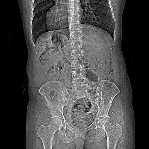 Coronal CT Abdomen - Abdomen and Pelvis CTs - embodi3D.com