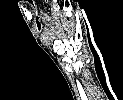 Wrist CT - Upper Extremity CTs - embodi3D.com