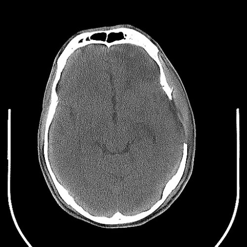 BRAIN CT 3 CT BRAIN MISSING SKULL - Skull, Head, and Neck CTs ...