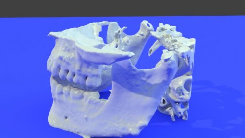 3D teeth printable model - stl file processed - Dental, Orthodontic ...