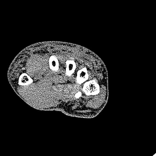 ct wrist - Upper Extremity CTs - embodi3D.com