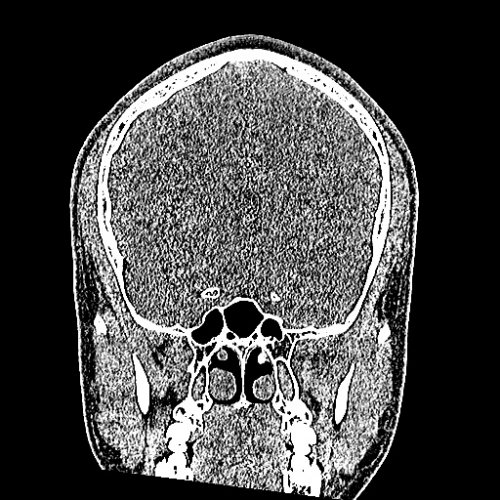 head and neck ct scan - Skull, Head, and Neck CTs - embodi3D.com
