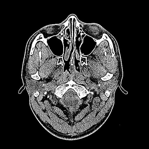head and neck ct scan - Skull, Head, and Neck CTs - embodi3D.com