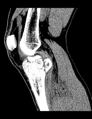 Knee Scan - Lower Extremity CTs - embodi3D.com