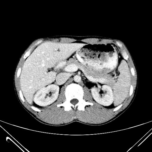 LT CT SCAN Muscle - Abdomen and Pelvis CTs - embodi3D.com