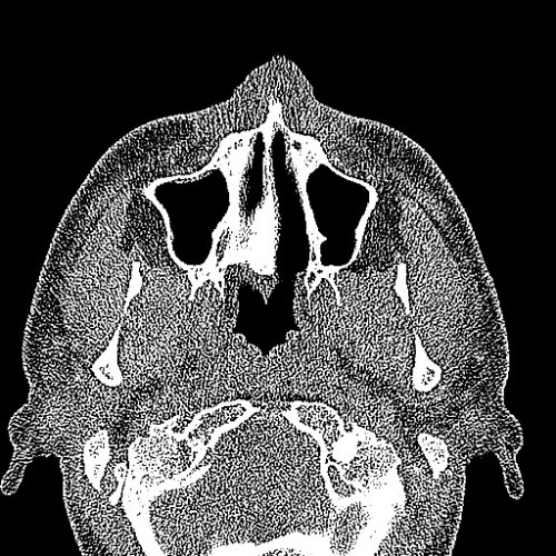 Skull CT Scan - Skull, Head, and Neck CTs - embodi3D.com