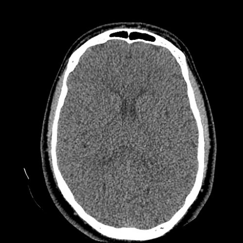 CT Scan - Skull, Head, and Neck CTs - embodi3D.com