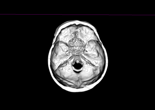 Tumor at the base of the skull - Skull and Face - embodi3D.com