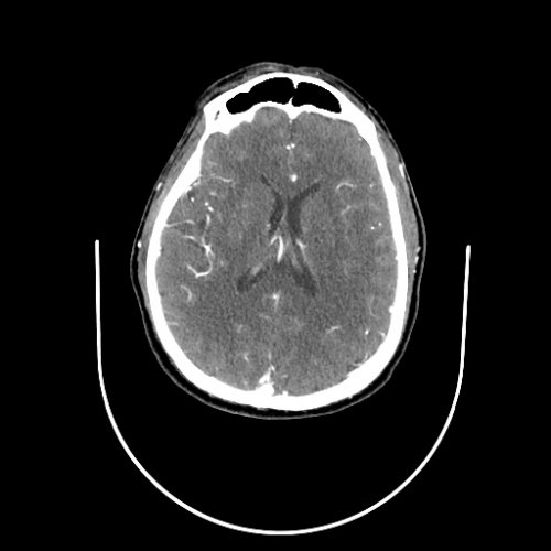 EXAM: CTA Brain and Neck with Intravenous Contrast - Skull, Head, and ...