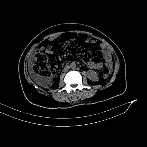 ct scan whole body - Abdomen and Pelvis CTs - embodi3D.com