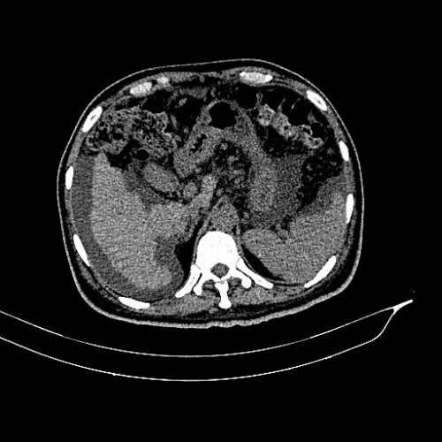 ct scan whole body - Abdomen and Pelvis CTs - embodi3D.com