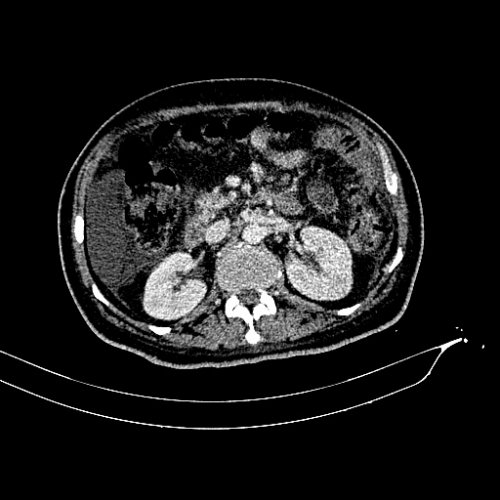 ct scan whole body - Abdomen and Pelvis CTs - embodi3D.com