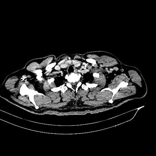 ct scan whole body - Abdomen and Pelvis CTs - embodi3D.com