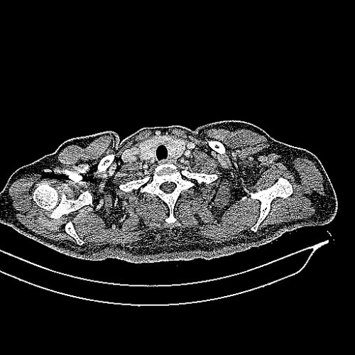 ct scan whole body - Abdomen and Pelvis CTs - embodi3D.com