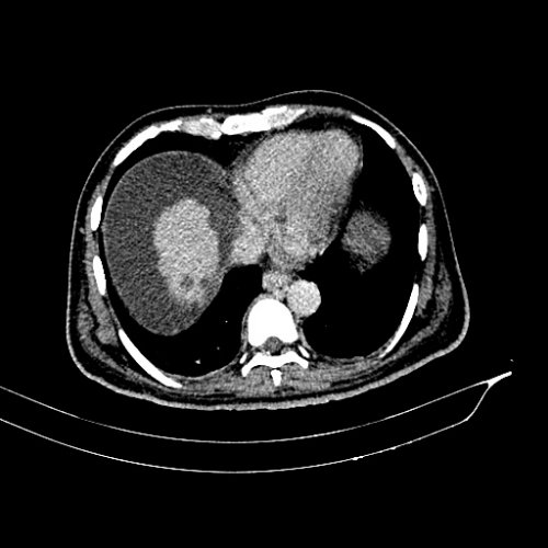 ct scan whole body - Abdomen and Pelvis CTs - embodi3D.com